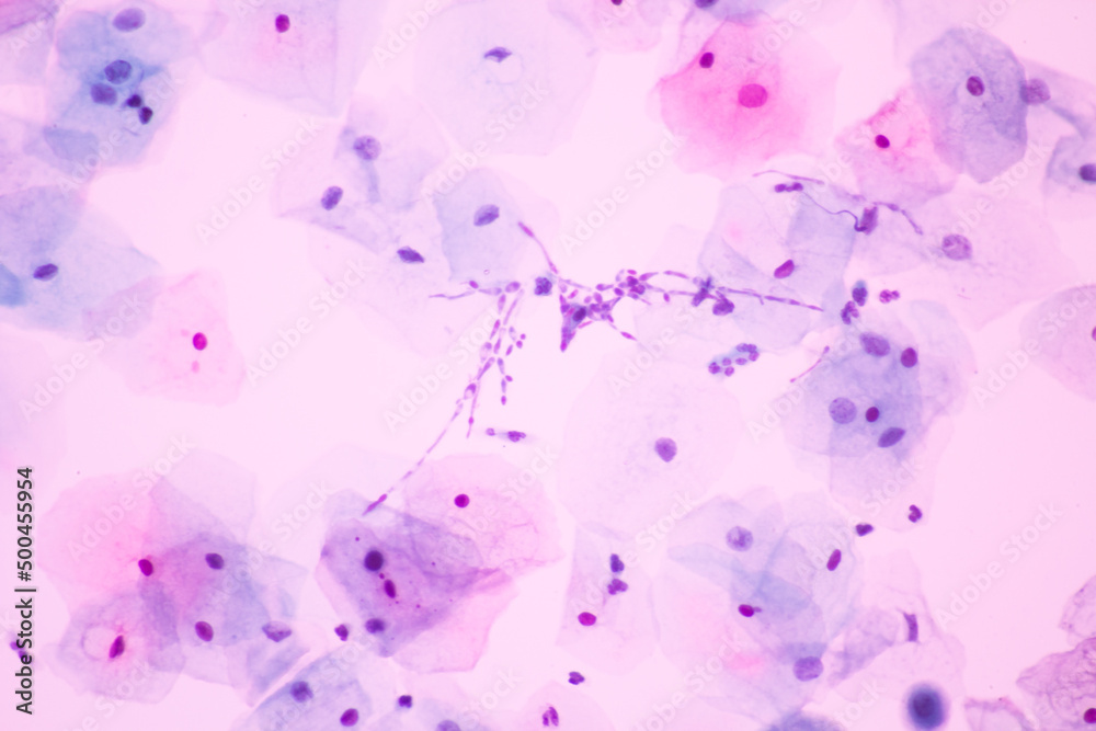 View in microscopic of Candidiasis, fungus infection (Yeast and ...