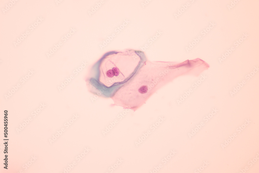 Foto de Abnormal squamous epithelial cells view in microscopy.HPV ...