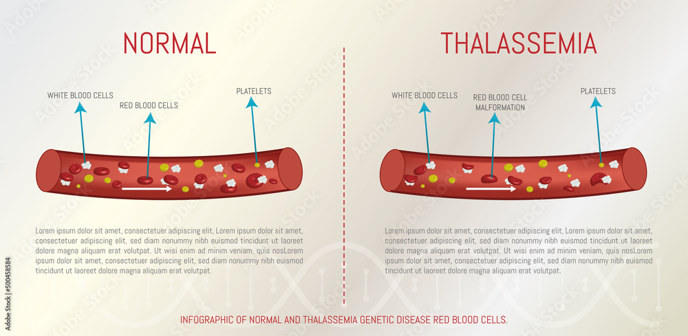 Infographic of normal and thalassemia genetic disease red blood cells ...