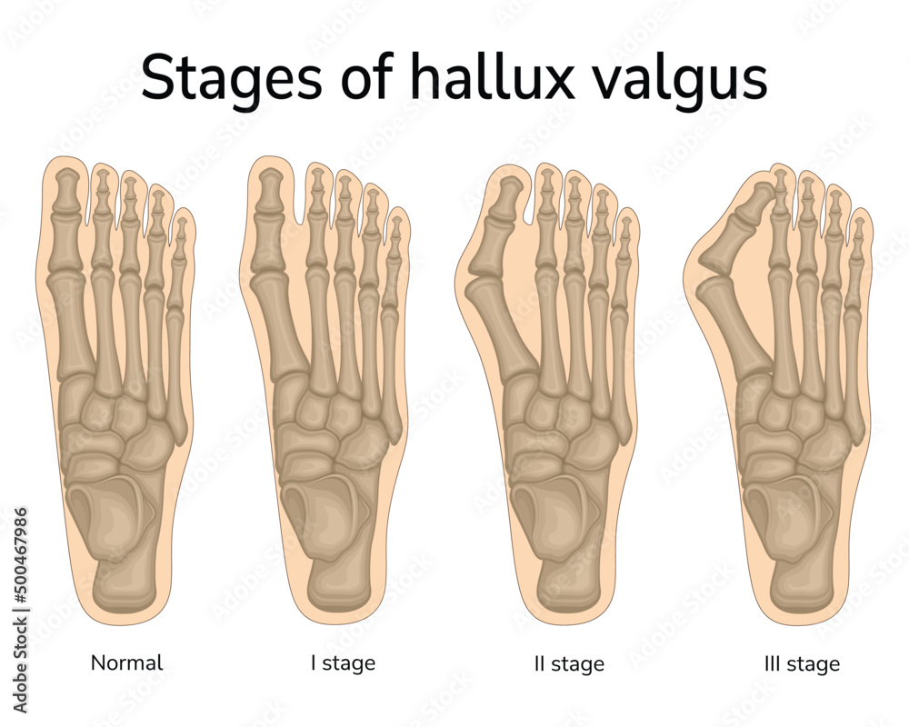 Three Stages Of Valgus Deformity Of The Big Toe Stock Vector Adobe Stock