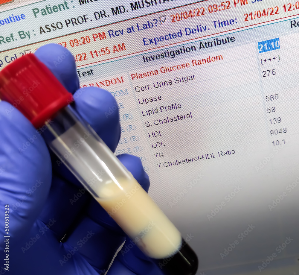 What Is A Lipemic Blood Sample at Brenda Gilland blog