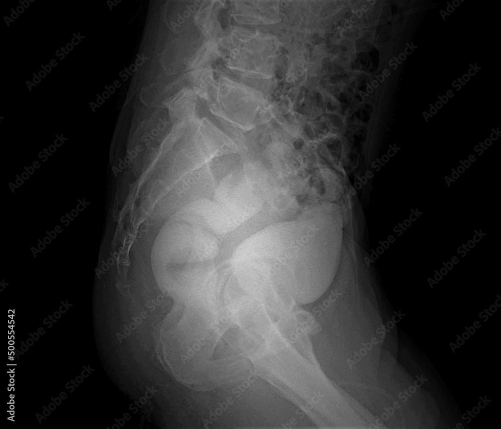 X-ray image of rectovesical fistula A barium enema contrast study ...