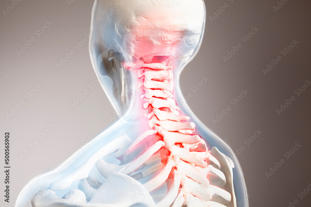 Neck pain, upper spine, cervical vertebrae spine, human body anatomy ...