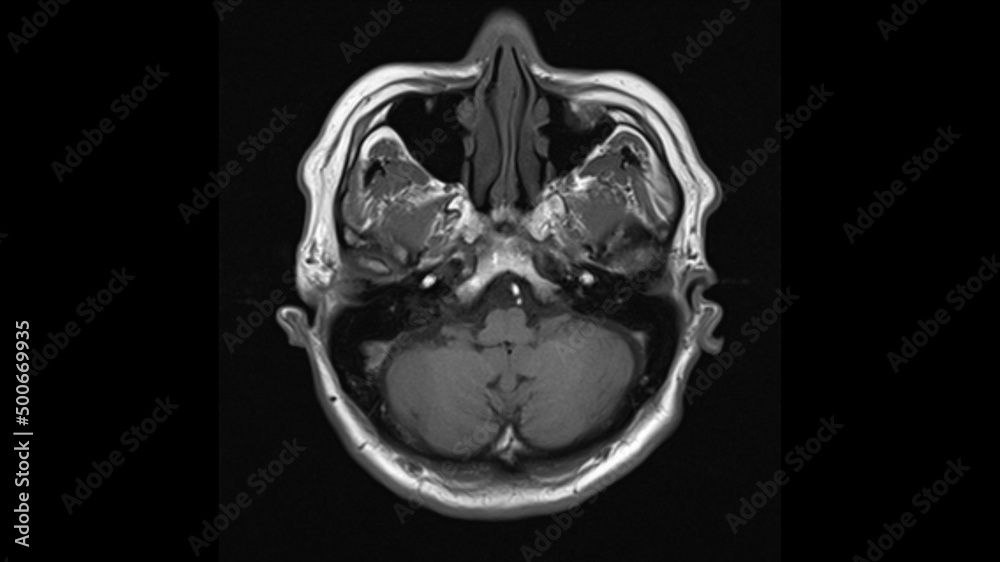 Foto de normal brain anatomy axial t1weighted MRI images do Stock ...