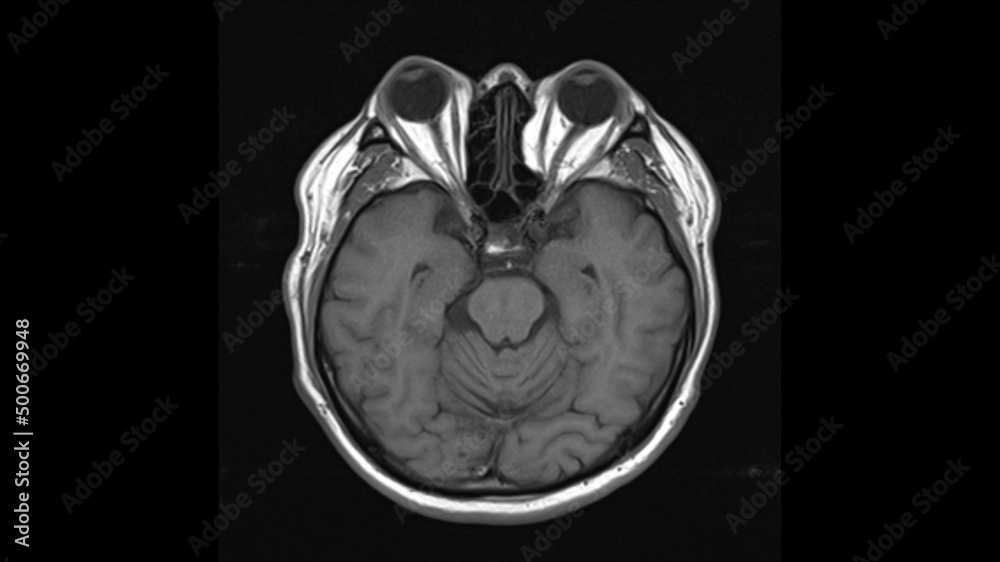 Poster normal brain anatomy axial t1weighted MRI images – Wall Art ...