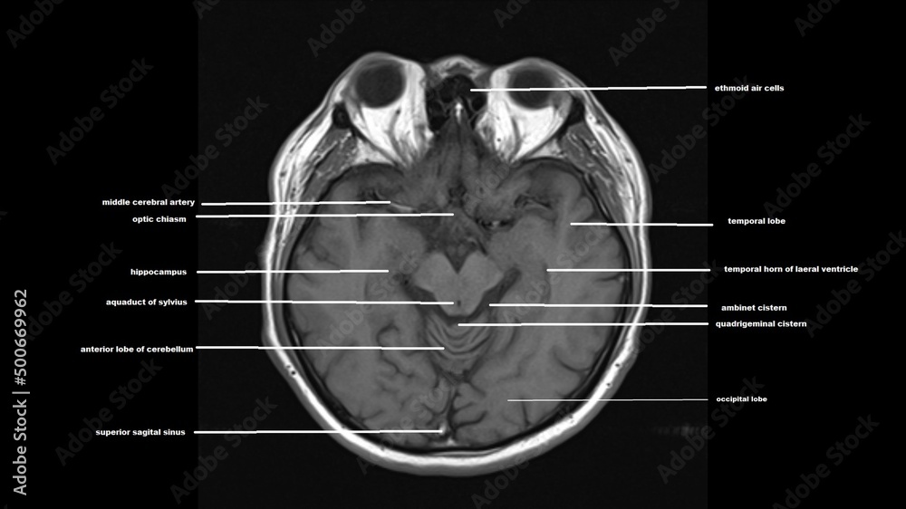 normal brain anatomy axial t1weighted MRI images Stock Photo | Adobe Stock