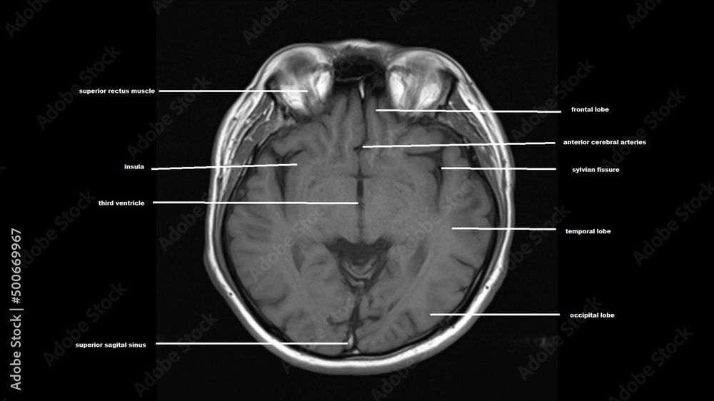 normal brain anatomy axial t1weighted MRI images Stock Photo | Adobe Stock
