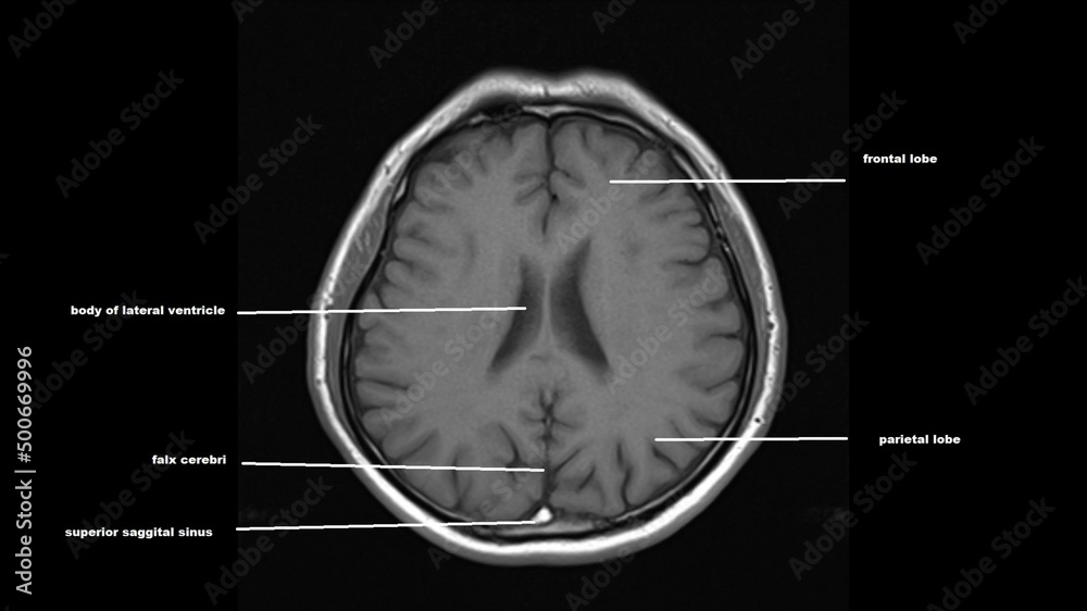 Poster normal brain anatomy axial t1weighted MRI images – Wall Art ...