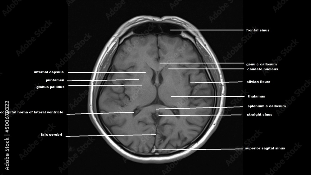 normal brain anatomy axial t1weighted MRI images Stock Photo | Adobe Stock