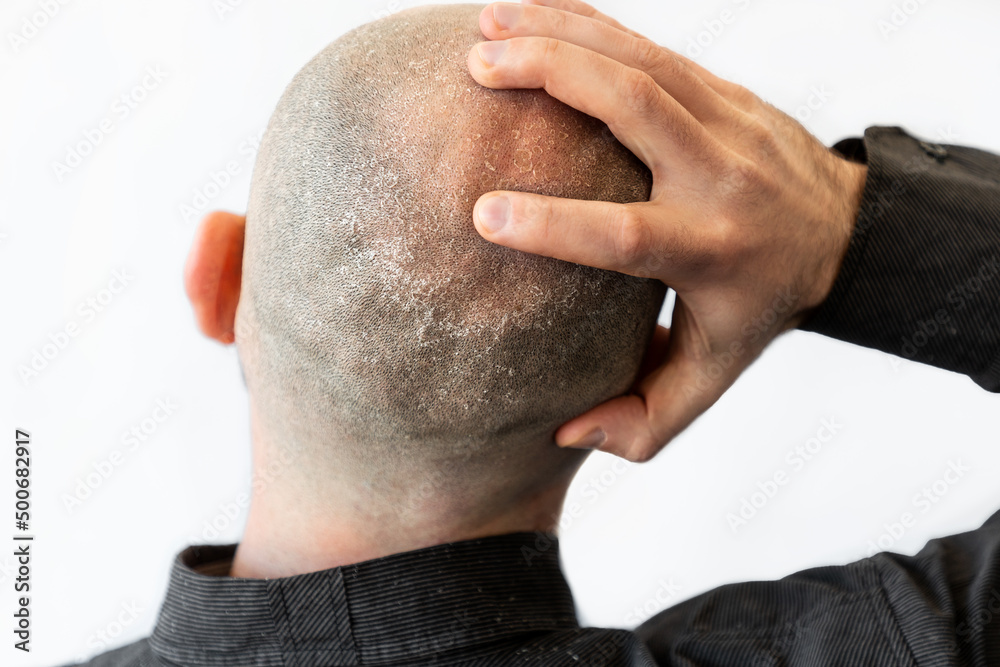 A man in a black shirt is holding his bald head covered with seborrheic ...