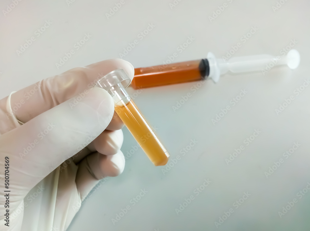 Sample cup with Pleural fluid which is ready for biochemical analysis ...