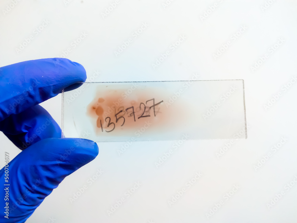 Peripheral blood smear in hematology department which is ready for ...