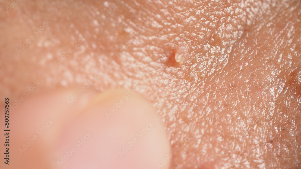 Wart skin removal. Macro shot of warts near eye on face. Papilloma on ...