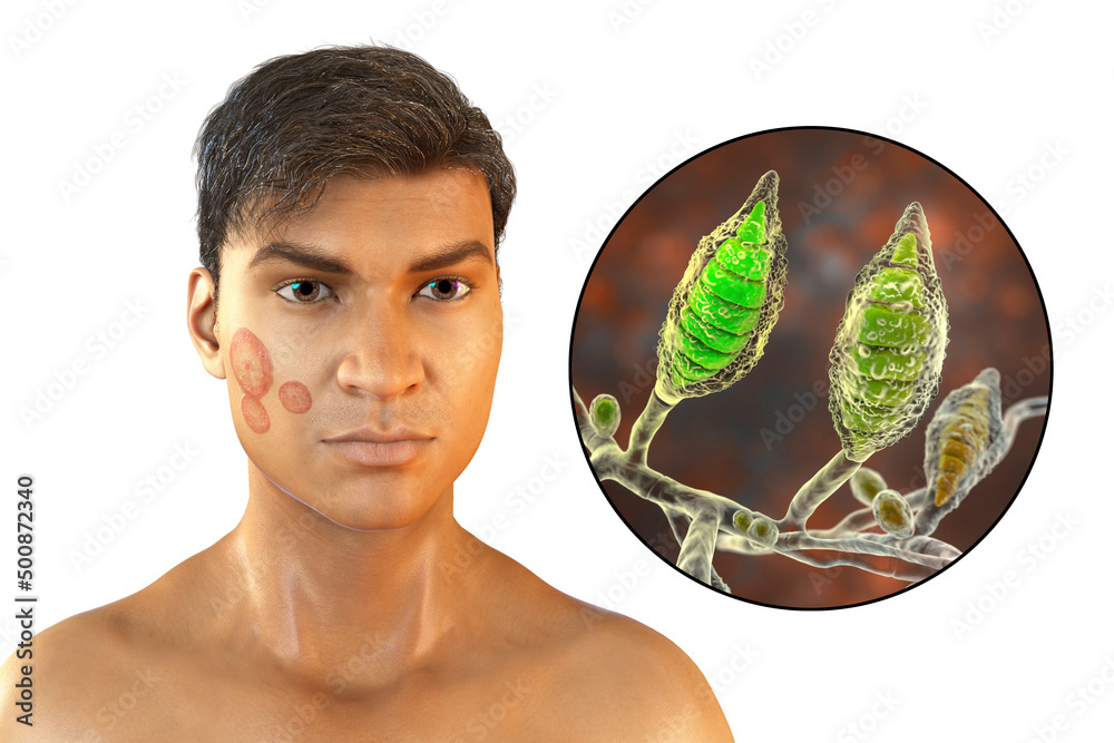 Fungal infection on a man's face, 3D illustration. Tinea faciei, caused ...