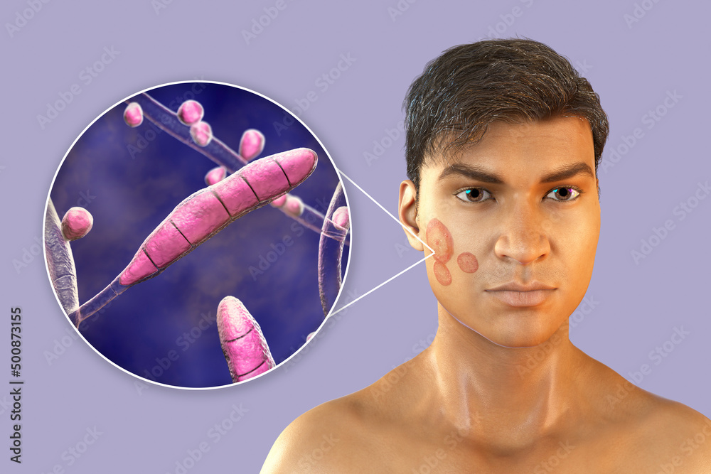 Fungal infection on a man's face, 3D illustration Stock Illustration ...