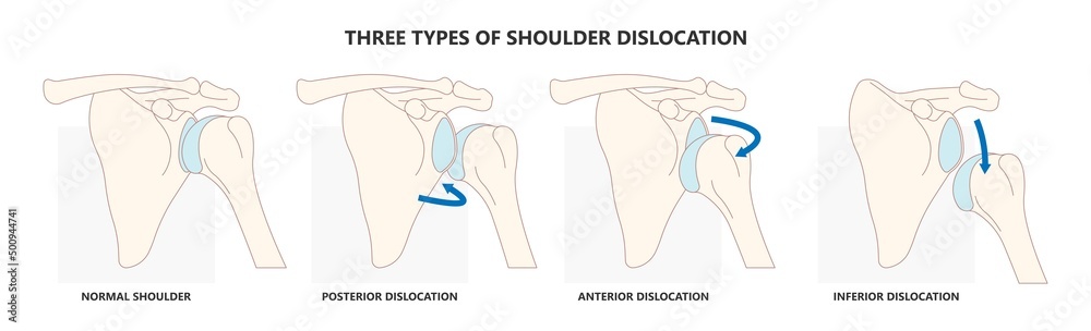 Shoulder dislocation X-ray joint arm sport lesion slap hill sachs tear ...