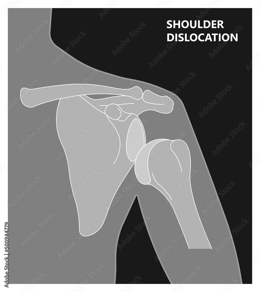 Shoulder dislocation X-ray joint arm sport lesion slap hill sachs tear ...
