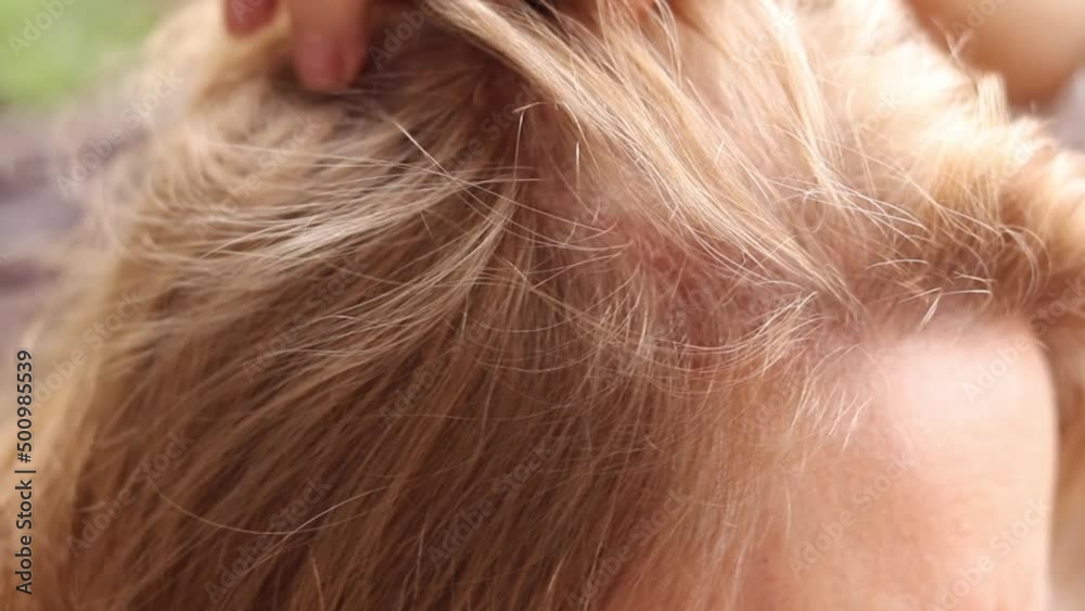 Seborrhea dermatitis dandruff skin condition on an itchy scalp. Woman ...