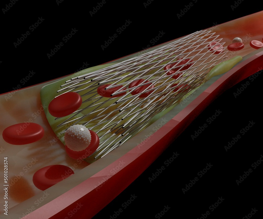 A stent is a mesh tube placed in a blood vessel. It's used to increase ...
