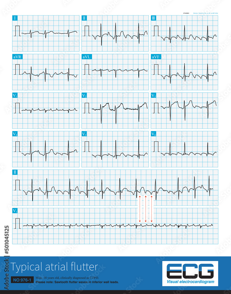 Male, 58 years old, clinically diagnosed as COPD. Paroxysmal atrial ...