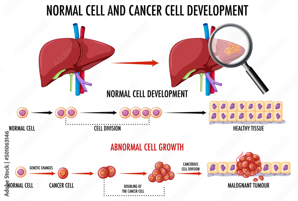 Diagram showing cancer development process Stock Vector | Adobe Stock