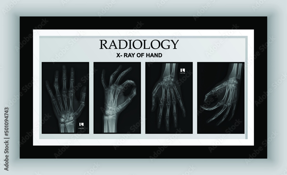 X-RAY OF HAND Stock Vector | Adobe Stock