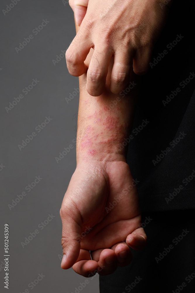 Close up allergic rash dermatitis eczema skin of patient wrist. Stock ...