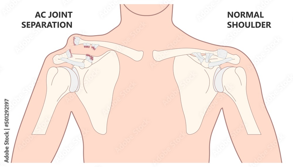Separation Dislocation The Ac Joint Fall Shoulder Bump Bruise Torn Cuff Tear Nerve Bone Broken