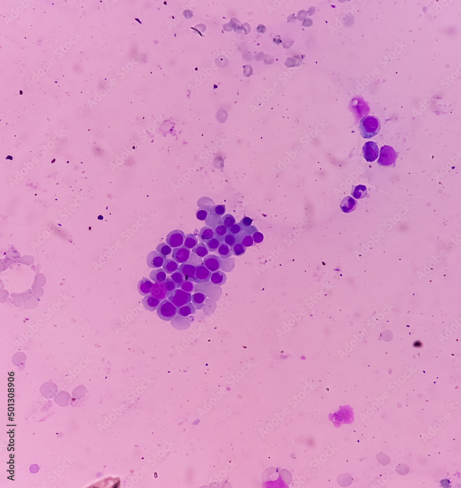 Bone marrow study: a megakaryocyte is a large bone marrow cell with a ...