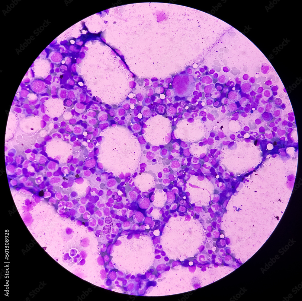 Bone marrow study: a megakaryocyte is a large bone marrow cell with a ...