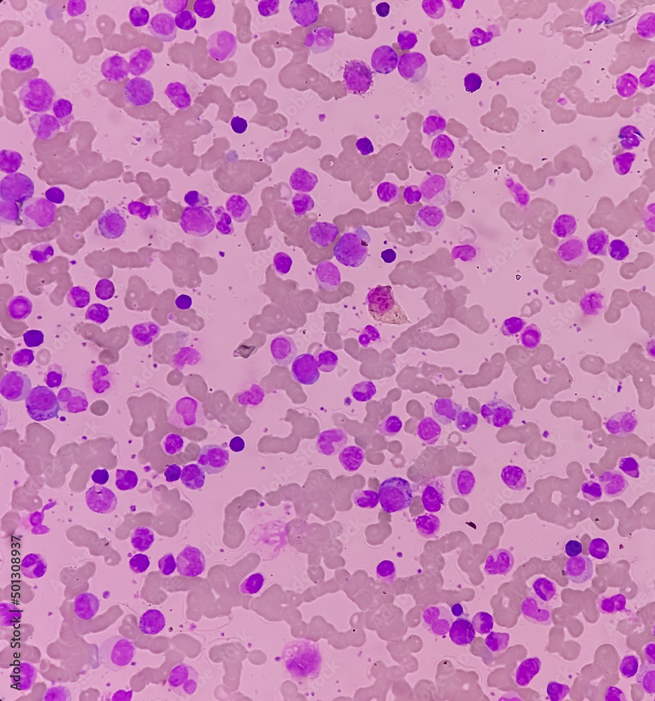 Chronic myeloid leukemia cells or CML, Microscopic examination show the ...