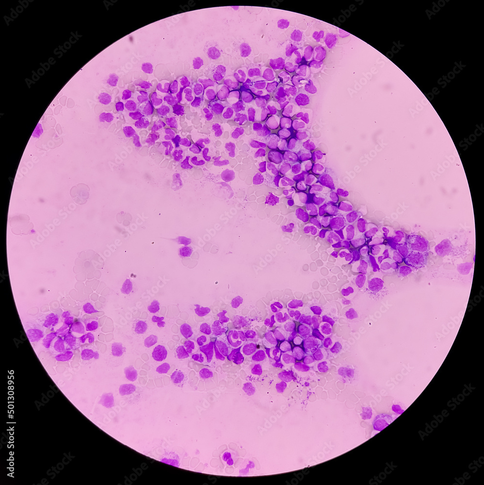 Chronic myeloid leukemia cells or CML, Microscopic examination show the ...
