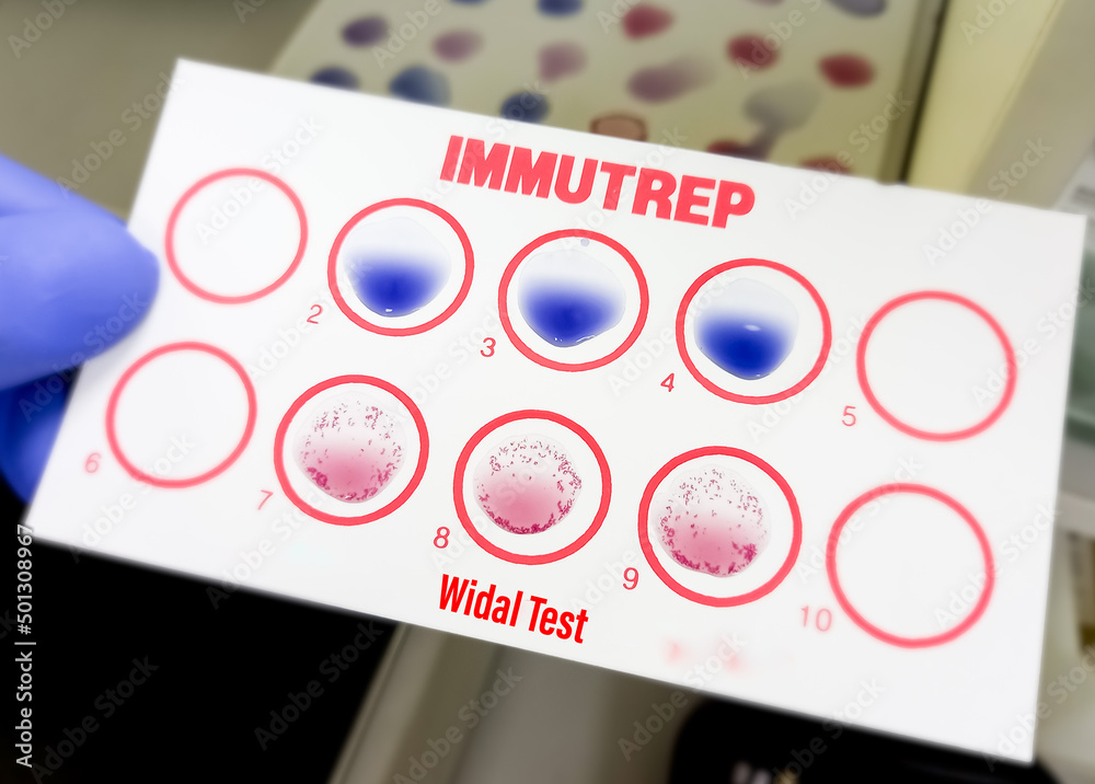 Widal test by agglutination method at plate isolated on white ...