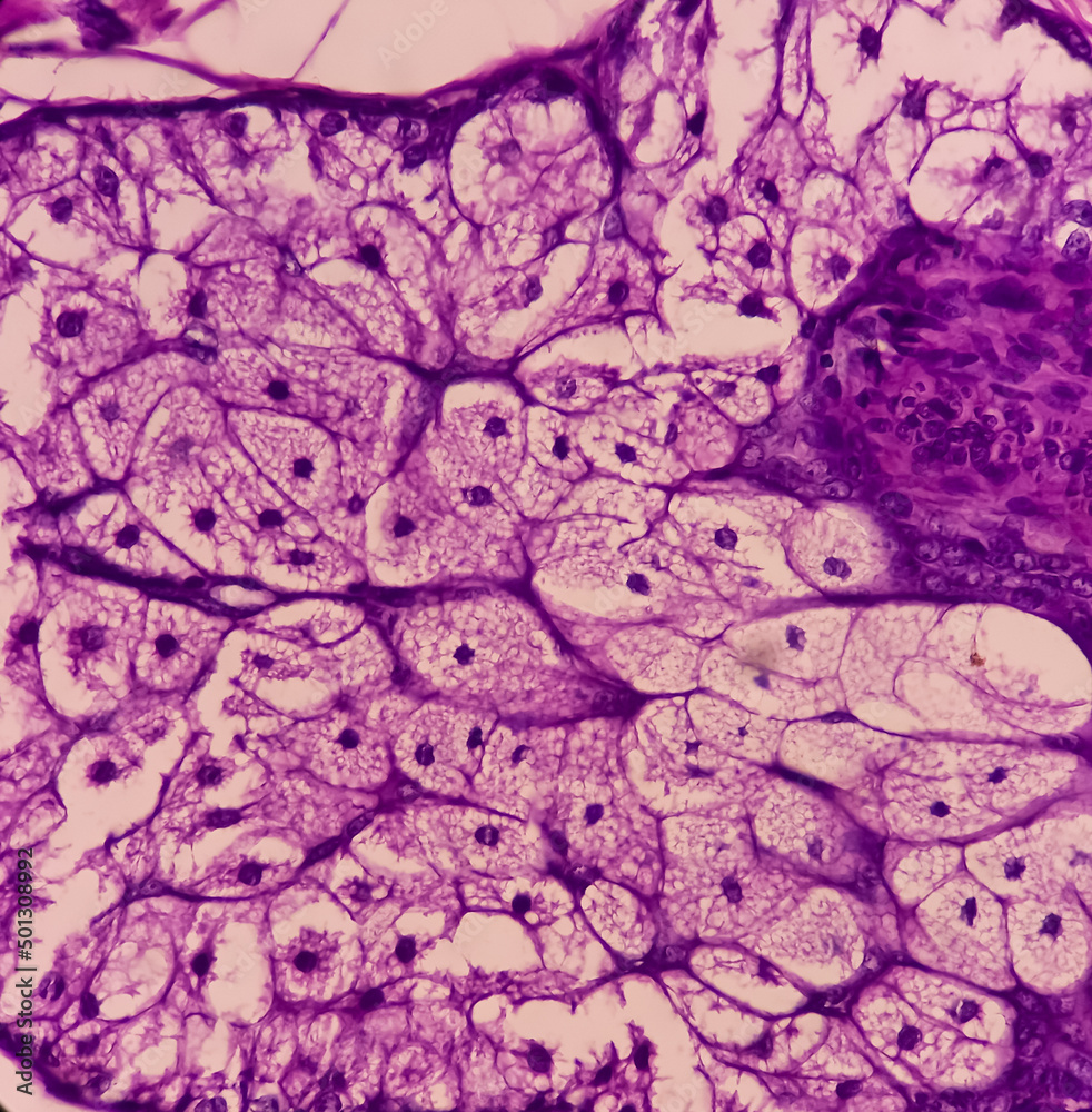 Pigmented nevus: Blue nevus of the skin. Notice the brown pigment in ...