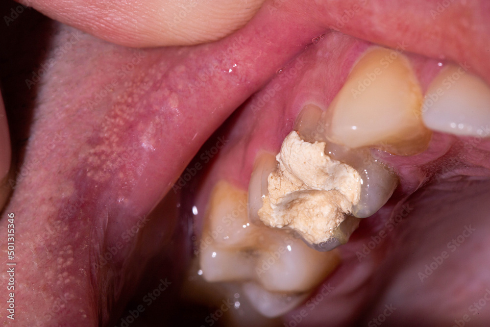 Tooth filling with temporary cement for root canal treatment. Tooth ...