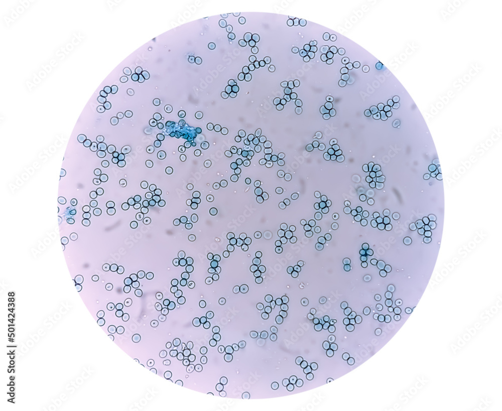 Close view of Reticulocyte count under microscope, methylene blue ...