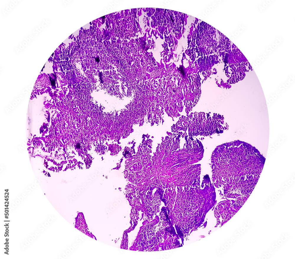 Tissue from terminal ileum: Chronic nonspecific ileitis or inflammation ...