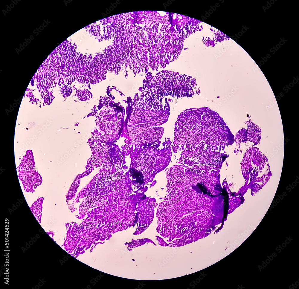 Tissue from terminal ileum: Chronic nonspecific ileitis or inflammation ...