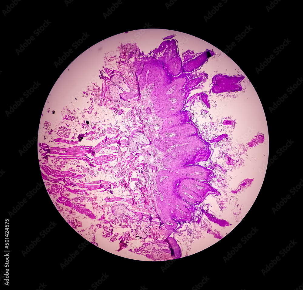 High magnification of skin cells infected with the HPV Virus. Common ...