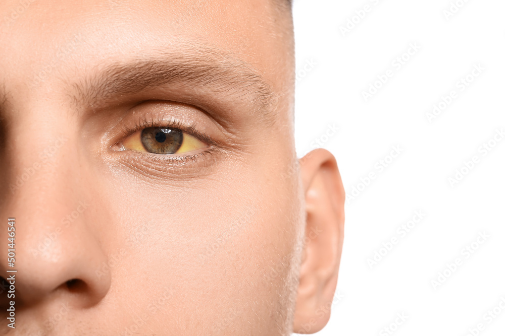 Young man with yellow eyes on white background, closeup. Hepatitis ...