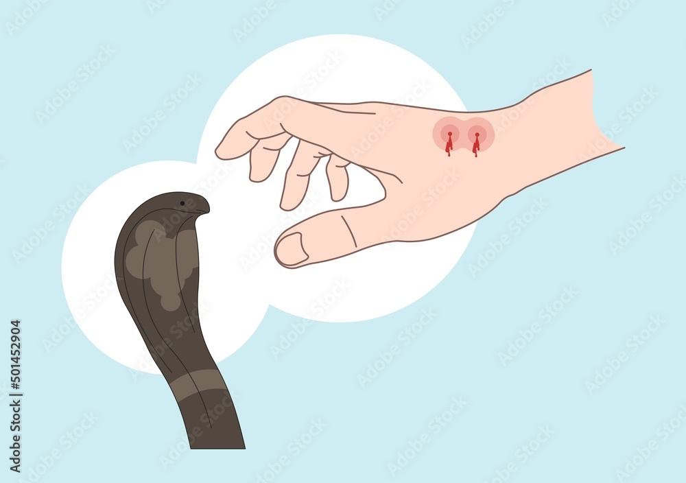 Snake Bite First Aid care non venomous anti venom serum hand leg king ...