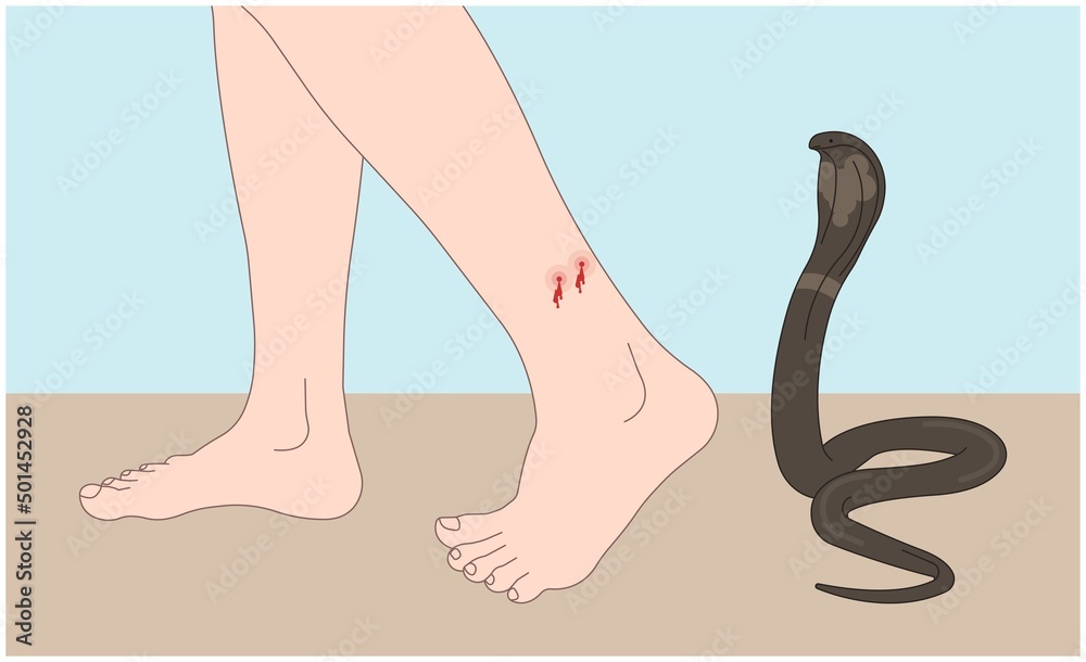 Snake Bite First Aid care non venomous anti venom serum hand leg king ...