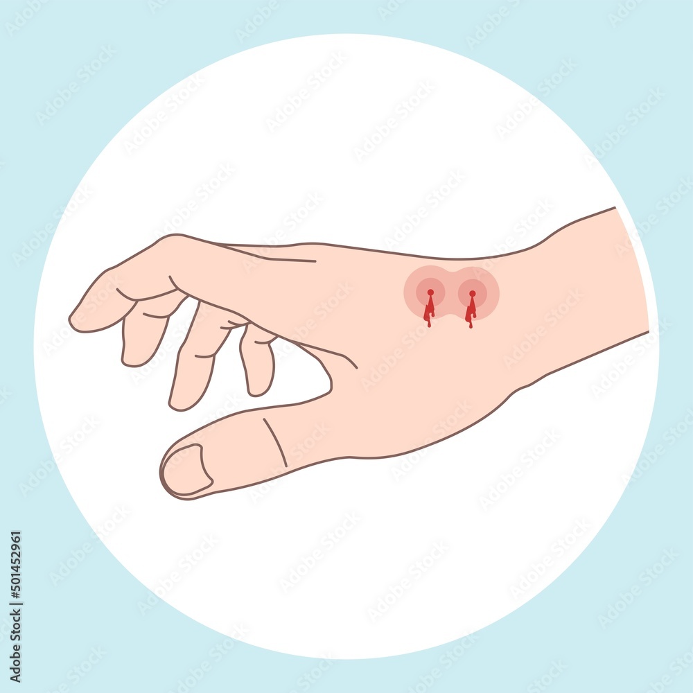 Snake Bite First Aid care non venomous anti venom serum hand leg king ...