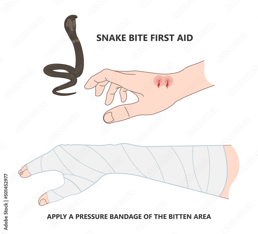 Snake Bite First Aid care non venomous anti venom serum hand leg king ...