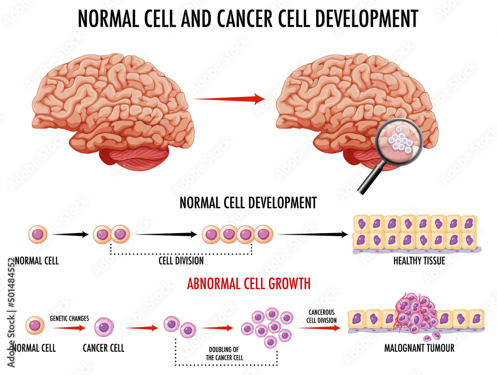 Cancer Cells And Normal Cells Diagram