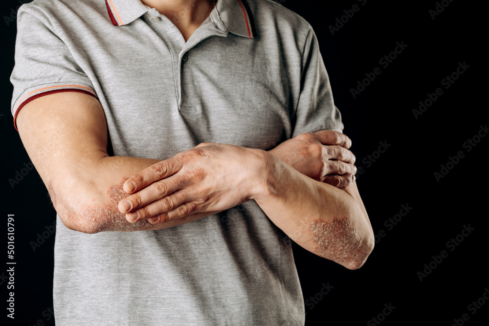Acute Psoriasis On The Elbows Is An Autoimmune Incurable Dermatological Skin Disease A Large