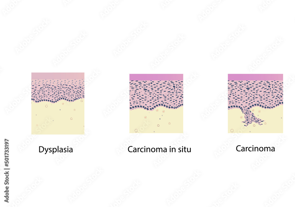 morphology of cervical cancer and cancerogenesis under a microscope ...