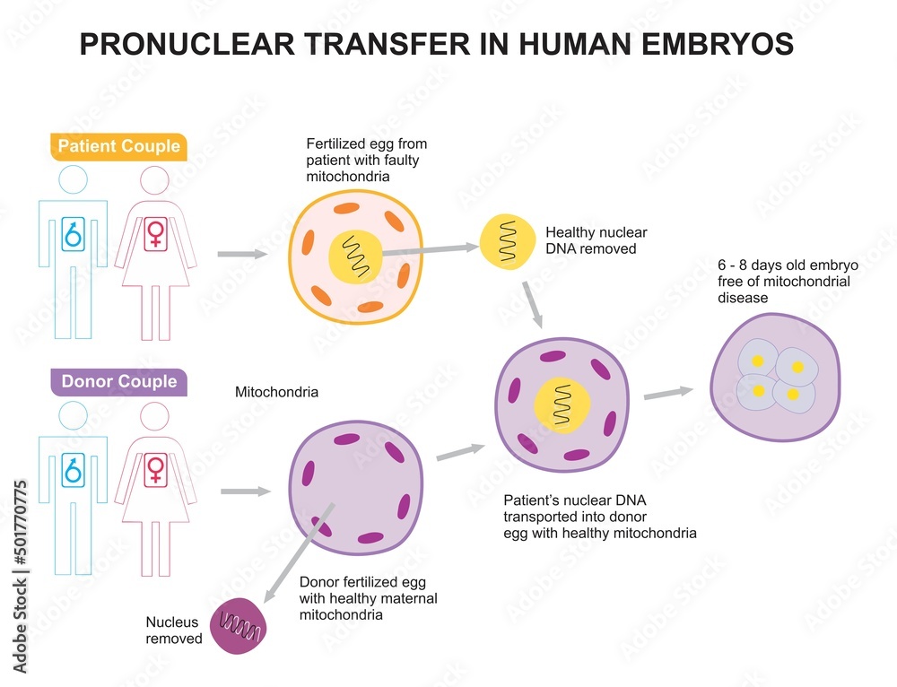 Pronuclear transfer in human embryo infographic diagram patient and ...
