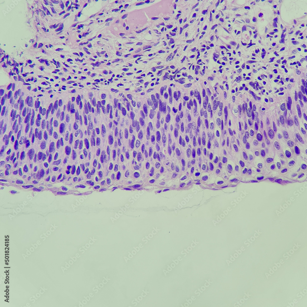 Foto de Camera photo of high-grade squamous dysplasia of the cervix ...