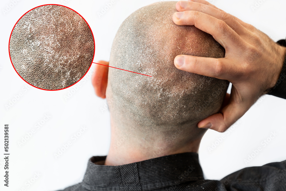 A man in a black shirt is holding his bald flaky head covered with ...
